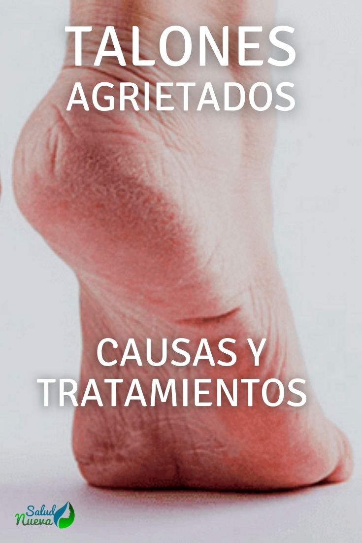 ¿Por qué se agrietan los talones? causas y tratamientos